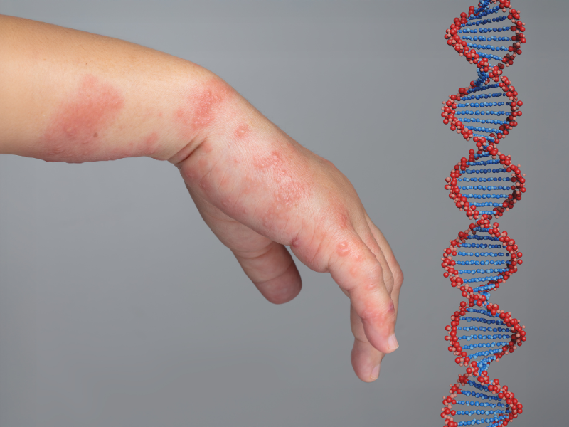 Topical Gene Therapy for Rare Skin Disease Gets Expanded Label | News ...